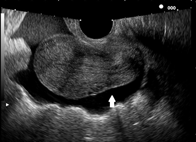 Hysterosalpingo Contrast Sonography | Women's Health | OneWelbeck